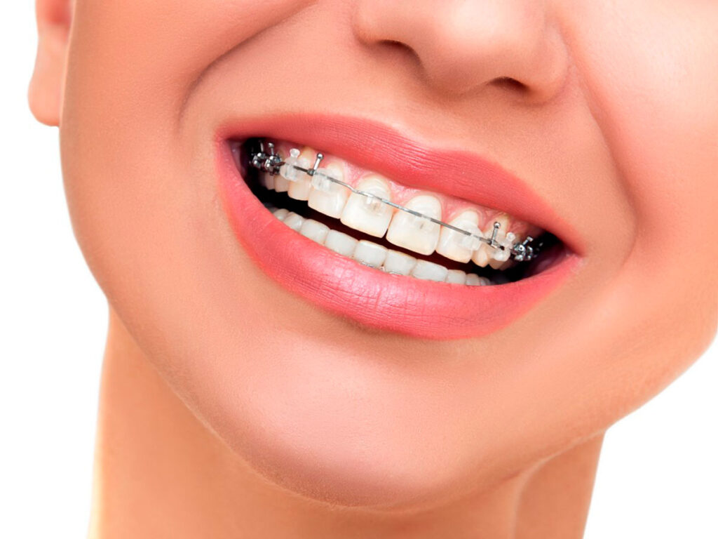 Brackets metálicos y estéticos: la solución para tu sonrisa ideal